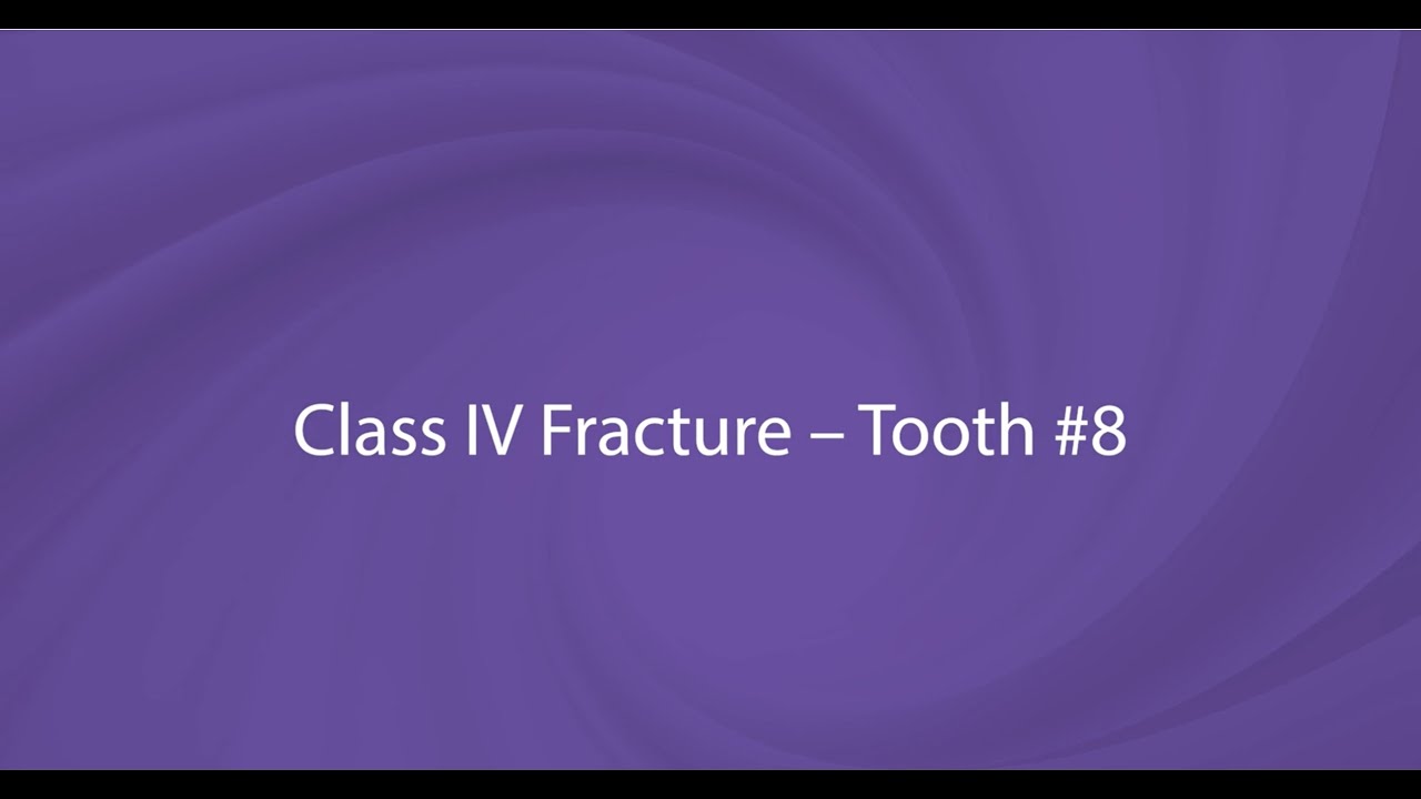 OMNICHROMA Procedure Video with Dr. Kevin Brown: Class IV Chipped Edge ...