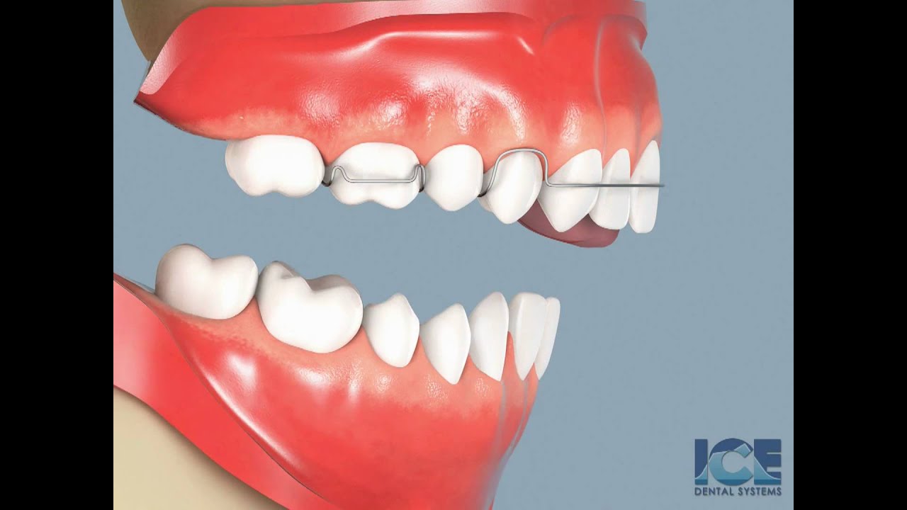 Anterior Openbite With Appliance Youtube