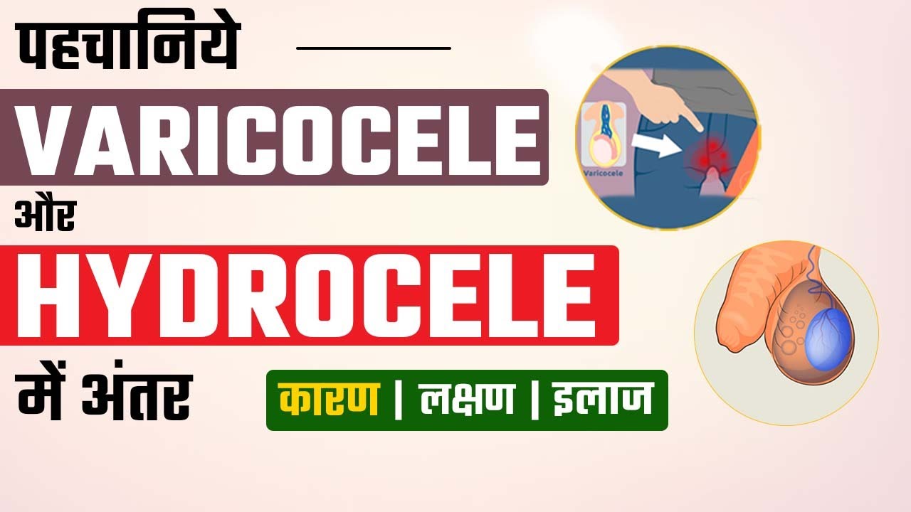 पहचानिये Varicocele और Hydrocele में अंतर Causes Of Varicocele