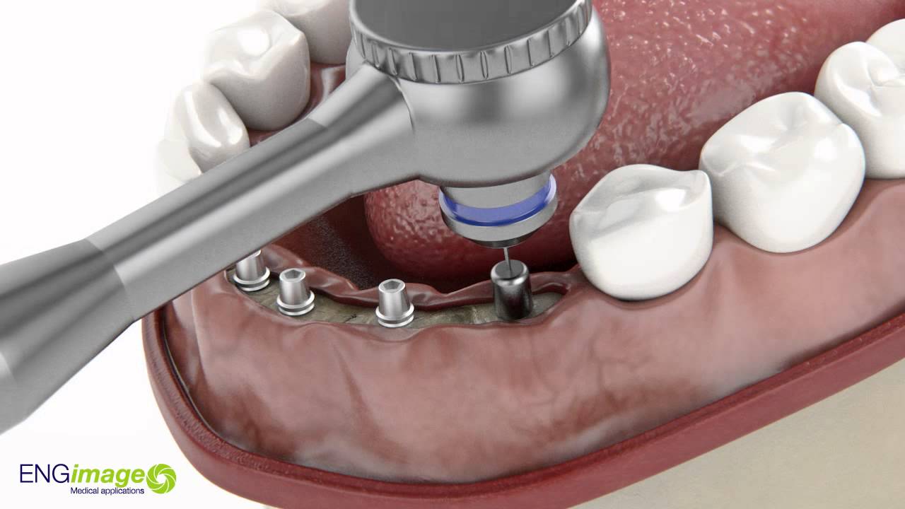LOC-IMPLANT, digital and radiological implant dental impressions - YouTube