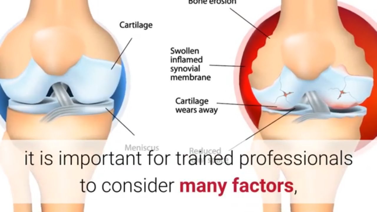 Inflammatory Polyarthritis Treatment Youtube
