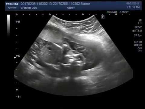 Ultrasound Video showing Anencephaly and encephalocele - YouTube
