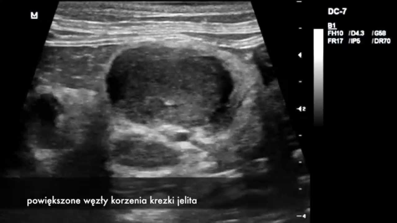 Biopsja pod kontrolą USG - YouTube