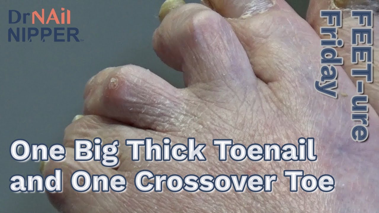 One Big Thick Toenail and One Crossover Toe. FEET-ure Friday (2023 ...