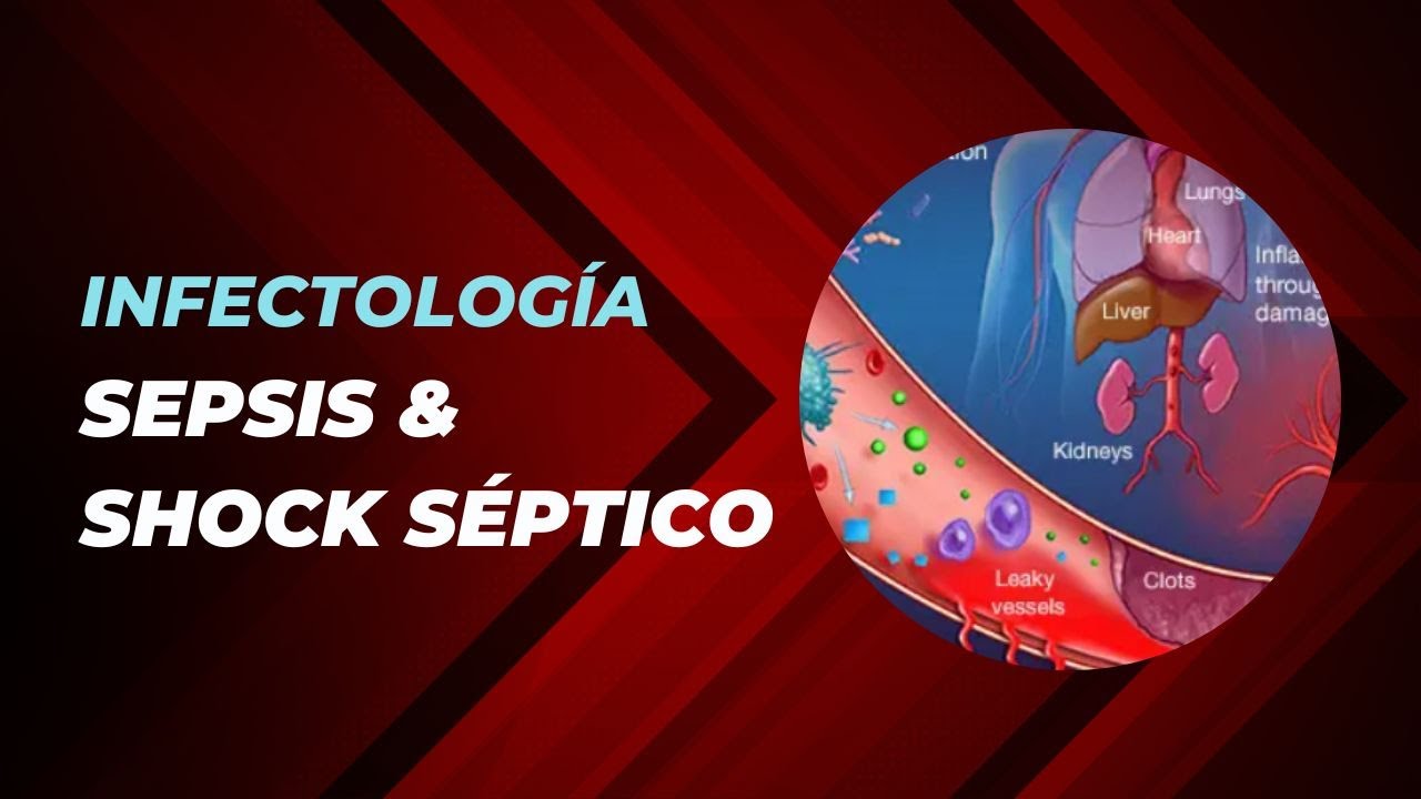 Medical Clinic / Sepsis and Septic Shock (AUDIO) / Spanish - YouTube