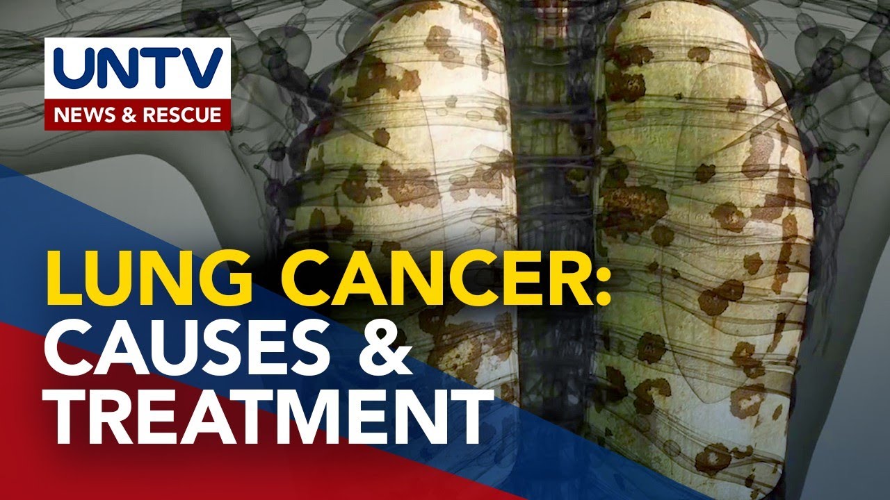 ALAMIN: Sintomas, Sanhi, at Paglaban sa Kanser sa Baga - YouTube