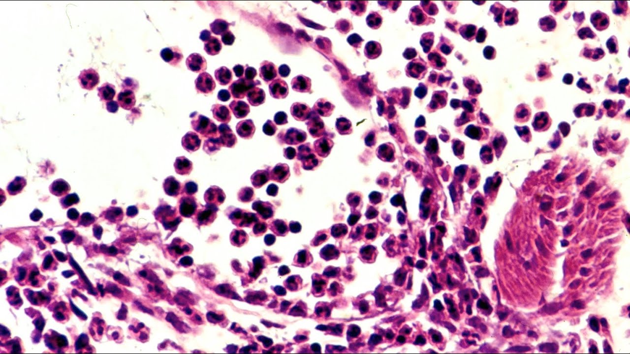 What Is Acute Inflammation Pathology Mini Tutorial YouTube what-is-acute-inflammation-pathology-mini-tutorial-youtube