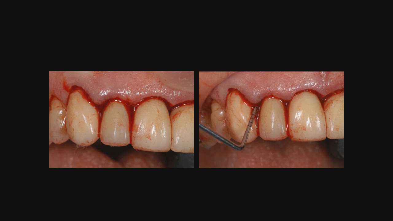 Clinical Significance of Embrasure Space Anatomy - YouTube
