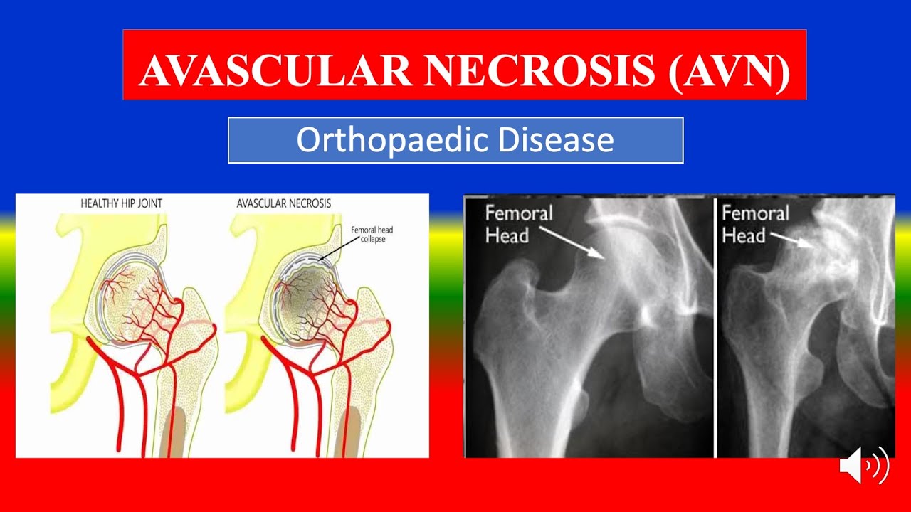 AVASCULAR NECROSIS (AVN) - Definition, types, causes, pathophysiology ...
