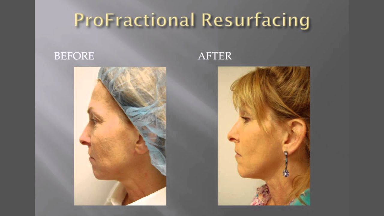 March 12th Seminar, Laser Skin Resurfacing, Pro Fractional - YouTube