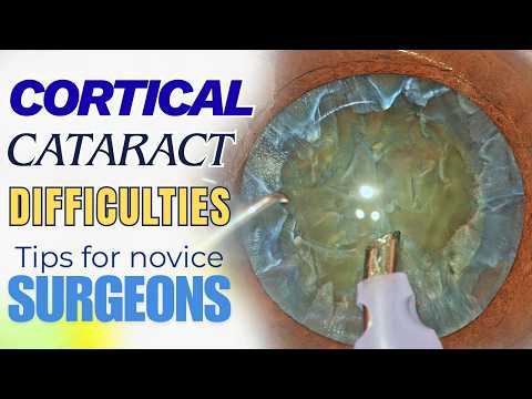 Difficulties in soft cataract, a beginner-friendly ultimate rescue technique: Dr. Deepak Megur