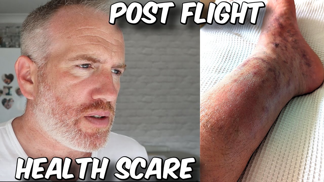 Health Scare - Suspected DVT - YouTube