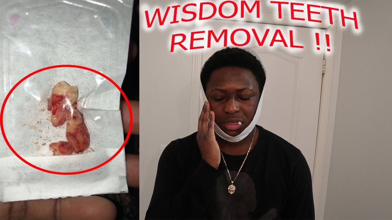 GETTING MY WISDOM TEETH REMOVED !! *FUNNY* - YouTube