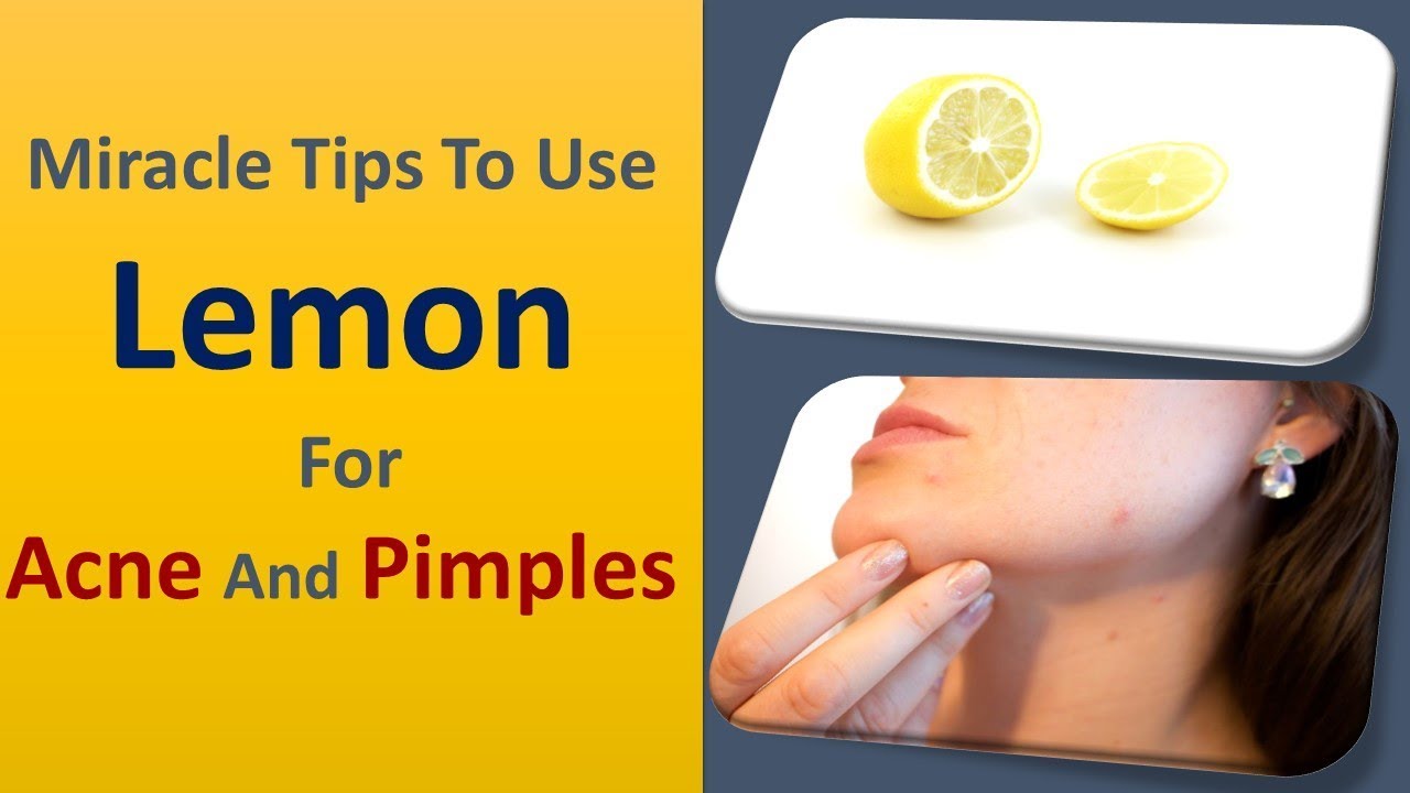 Miracle Tips To Use Lemon For Acne And Pimples - DIY Tricks For Acne At ...