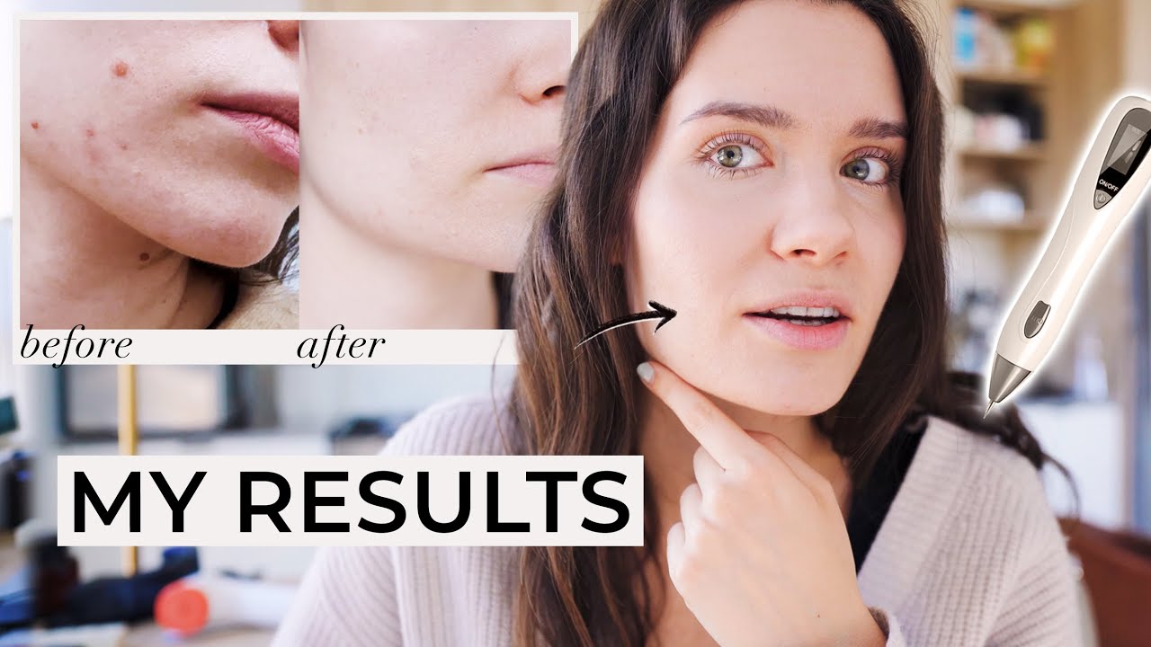 How to Get Rid of Skin Tags Moles Warts | PLASMA IQ vs PLASMA MOLE SKIN ...