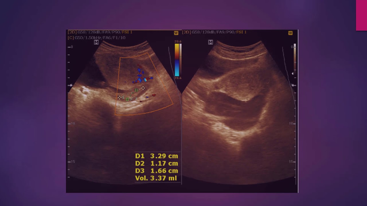 CA Sigmoid Colon Moderate Ascites - YouTube
