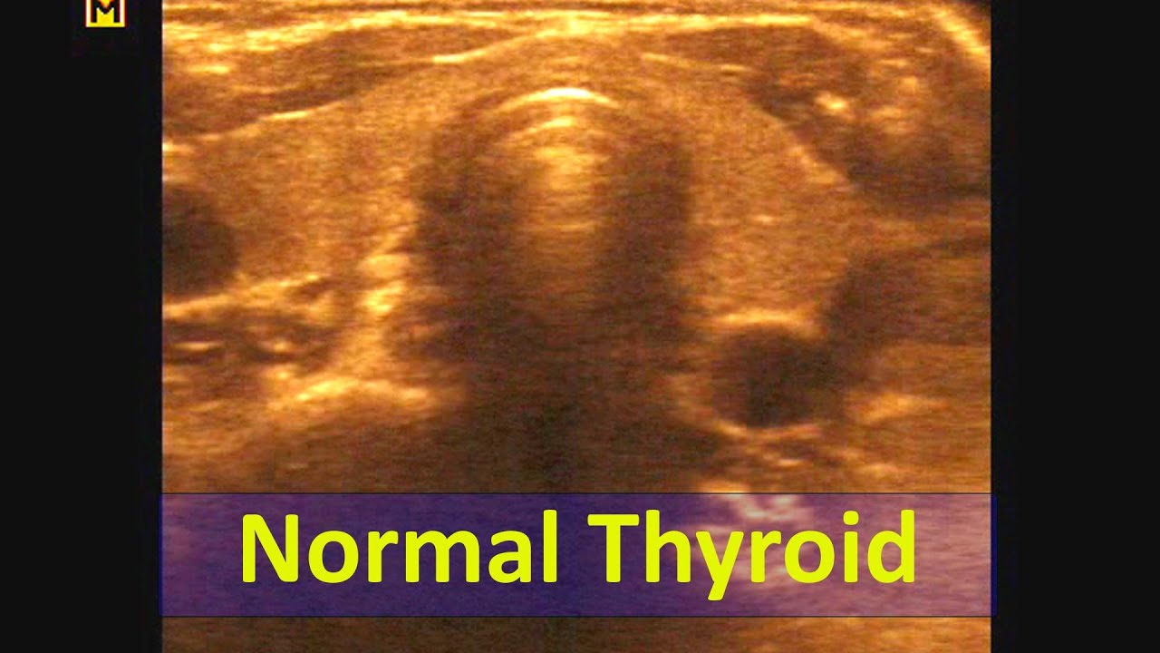 Ultrasound cases 33 of 2000 - || Video Showing Ultrasonography of ...