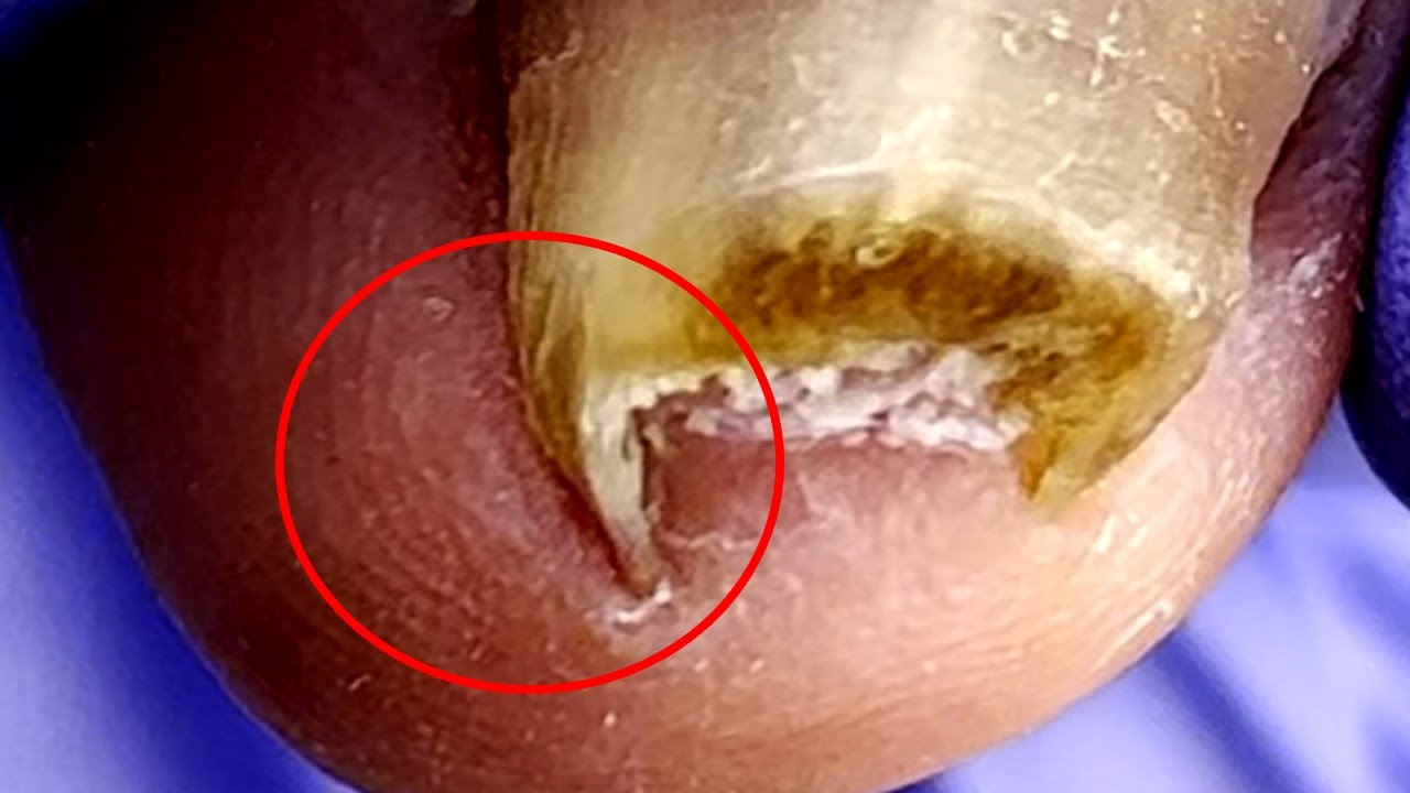 Curly ingrown toenails leave huge damage to toes【Xue Yidao Pedicure ...