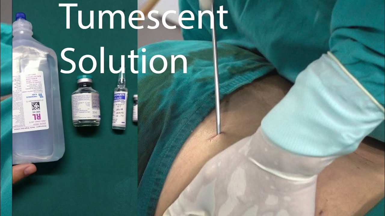 Dr. Kayser (Image By Design Plastic Surgery) injects the liposuction ...