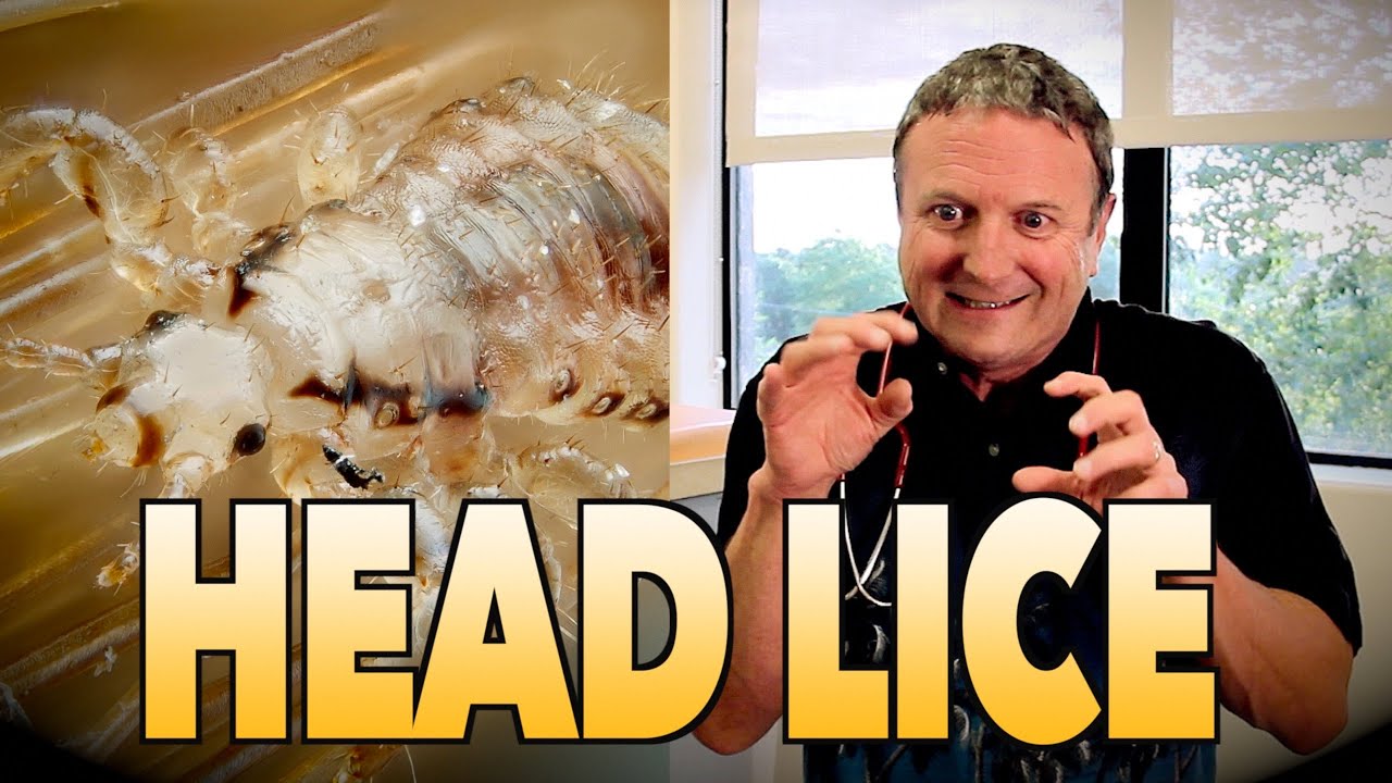 HEAD LICE: Everything You Need To Know + How To Get Rid of Them | Dr ...