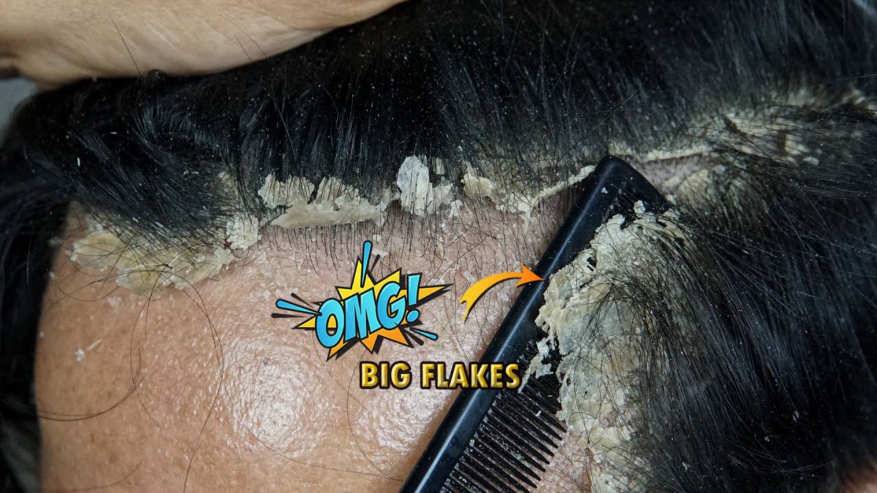 Satisfying Combing Dandruff Big Flakes #1136 - YouTube