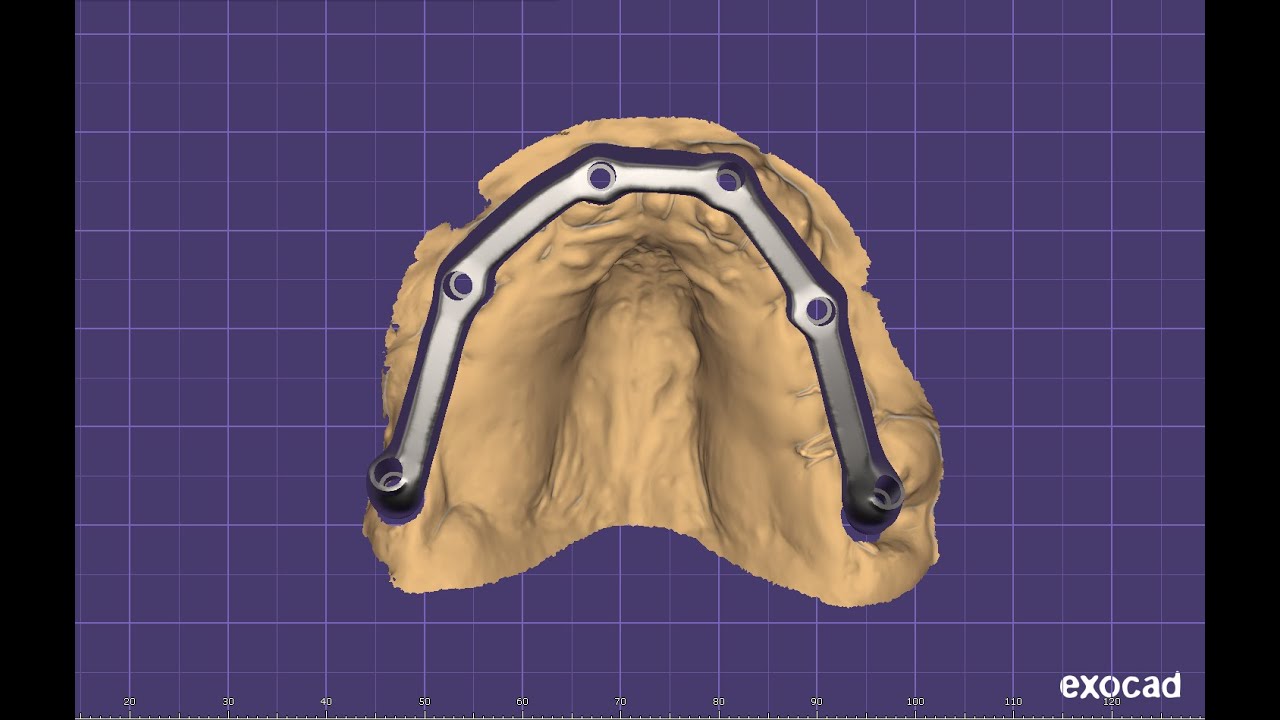 Upper All on 6 screw retained titanium bar designing in exocad with ...