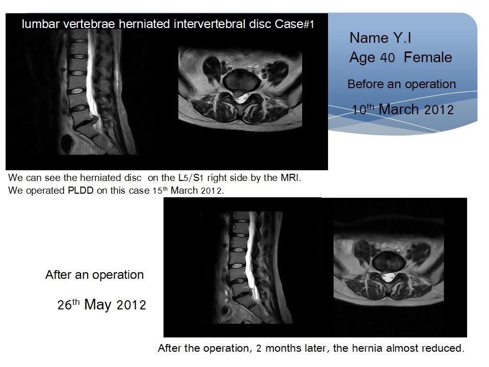 PLDD surgery for herniated disc MeguroYuaiClinic - YouTube