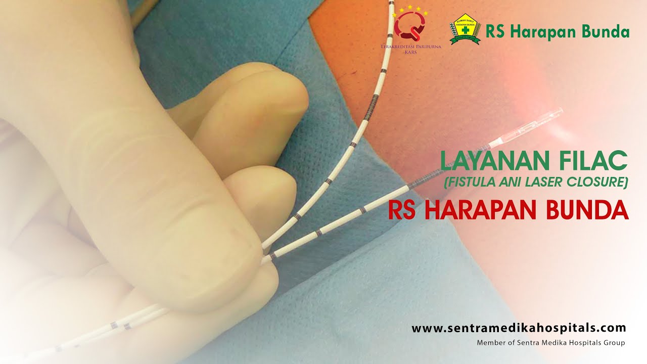 FILAC (Fistula Ani Laser Closure), Solusi tepat atasi Fistula Ani | RS ...