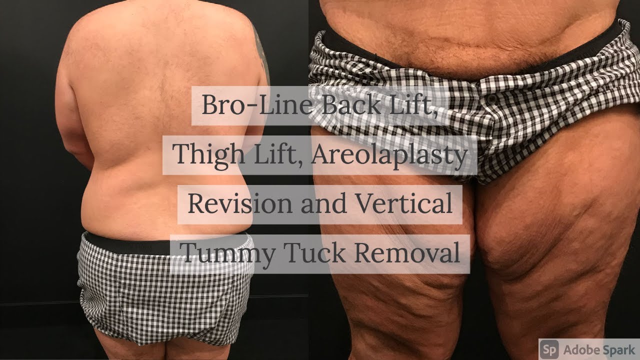 Dr Repta Performs A Bro Line Back Lift Thigh Lift Areolaplasty