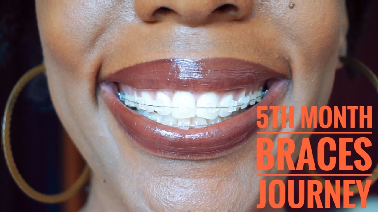 5th Month Braces Update | Time Lapse | Vlog #15 - YouTube