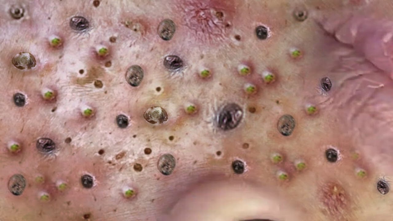 Loan Nguyen Acne Treatment 128c - YouTube