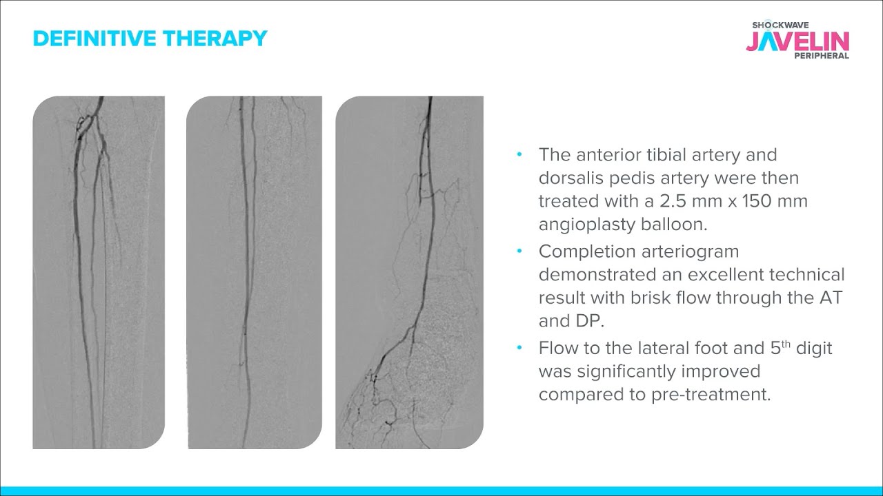 Shockwave Javelin: Diffuse, Calcified Tibial Artery Case Review with Dr ...