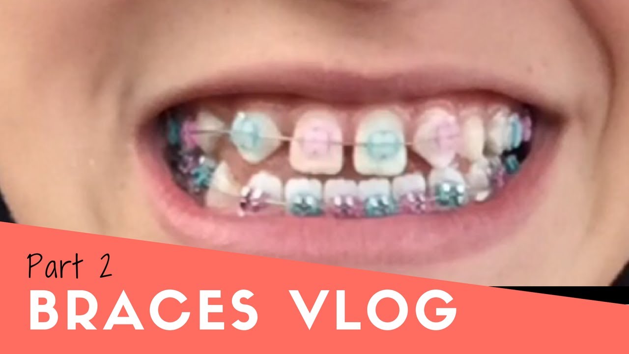 Braces Vlog || Part 2 - YouTube