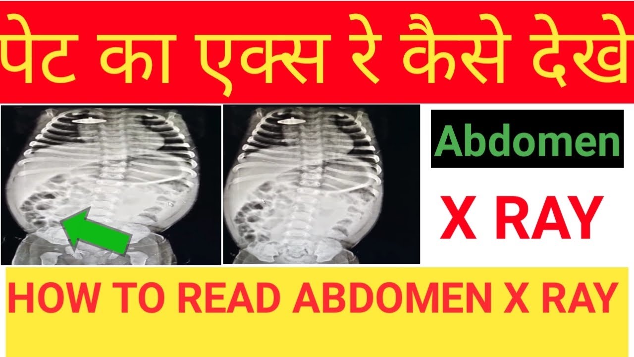 how to read abdomen x ray #x ray # पेट का एक्स रे कैसे देखे ...