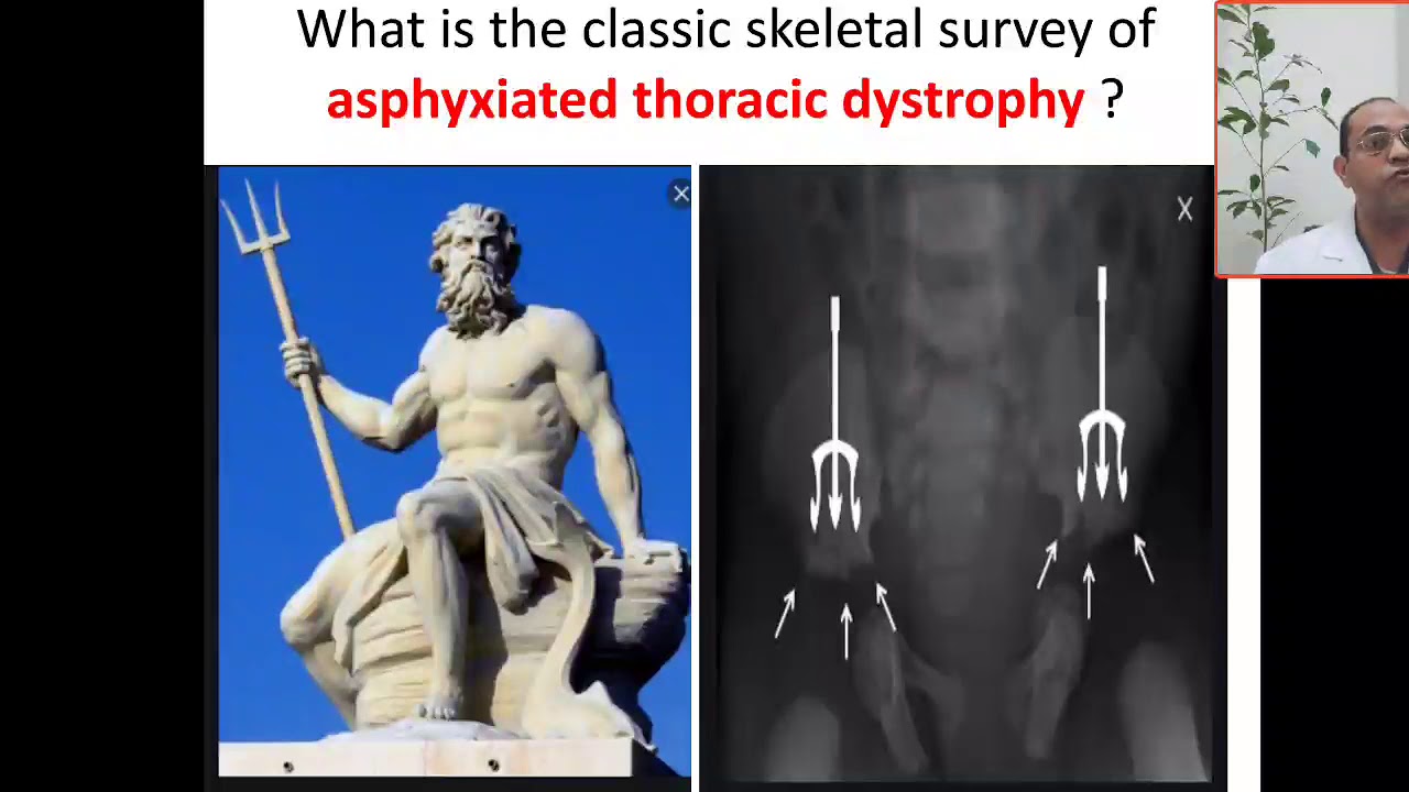 What's the classic skeletal survey of asphyxiated thoracic dystrophy ...