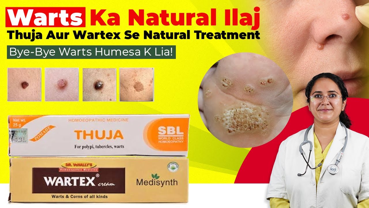 Warts Se Chutkara: Treatment with Thuja & Wartex Cream - YouTube