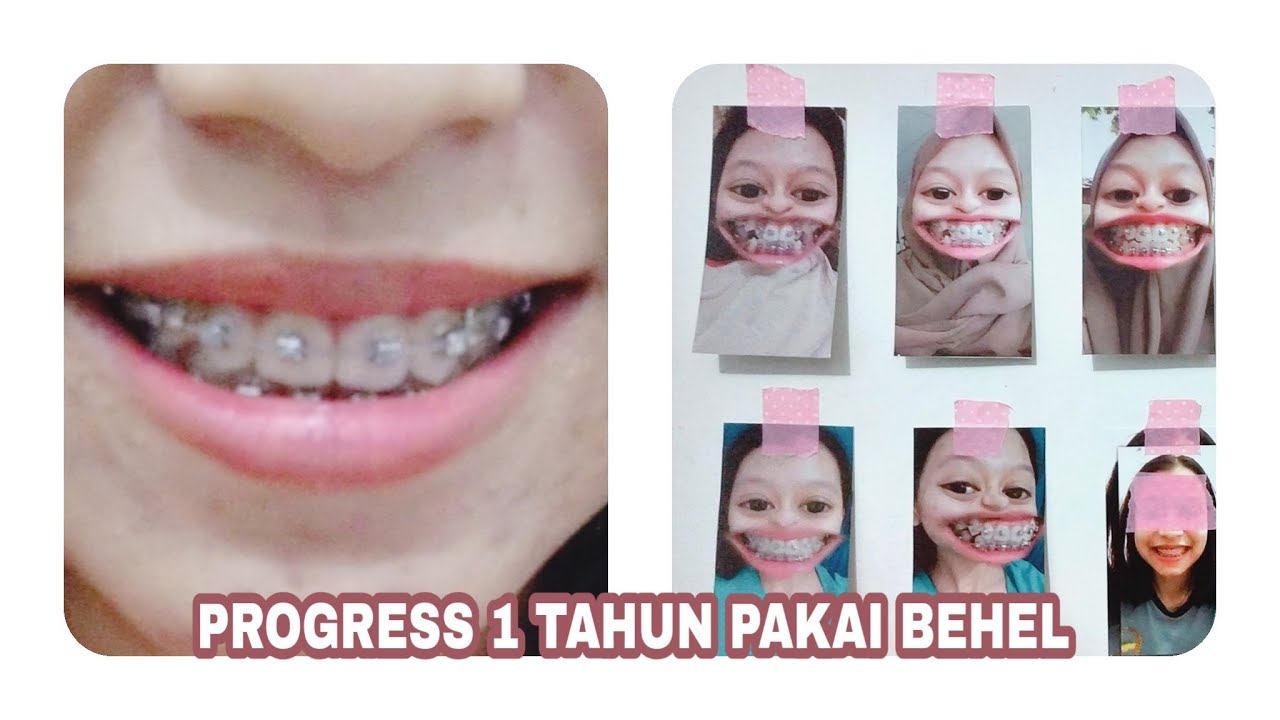 PENGALAMAN PASANG BEHEL DI RSGM UI | PROGRESS 1 TAHUN - YouTube