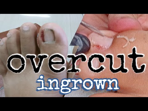 overcut ingrown toenail removal #nails #toenails - YouTube