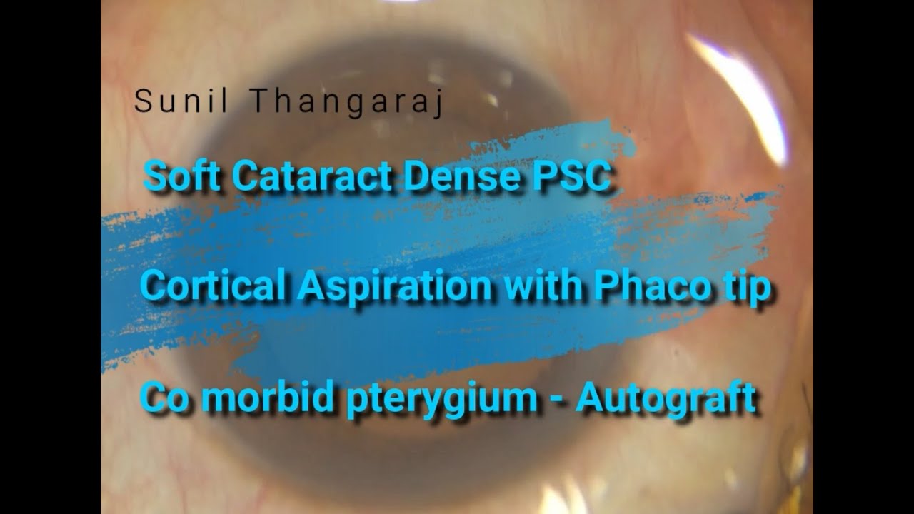 Soft cataract with dense PSC using phaco tip to clear Cortex - YouTube