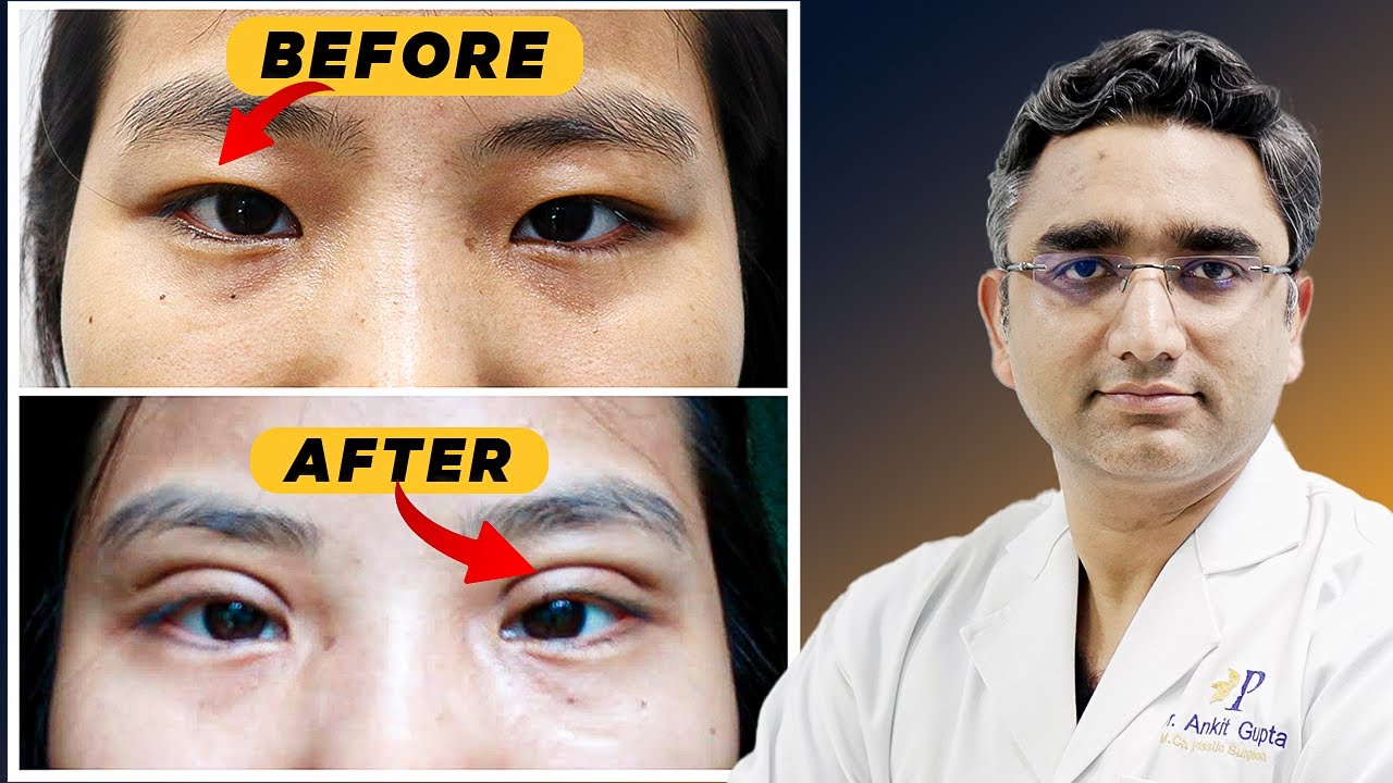 Asian Lid Blepharoplasty | Eye Lid Creation Surgery - YouTube