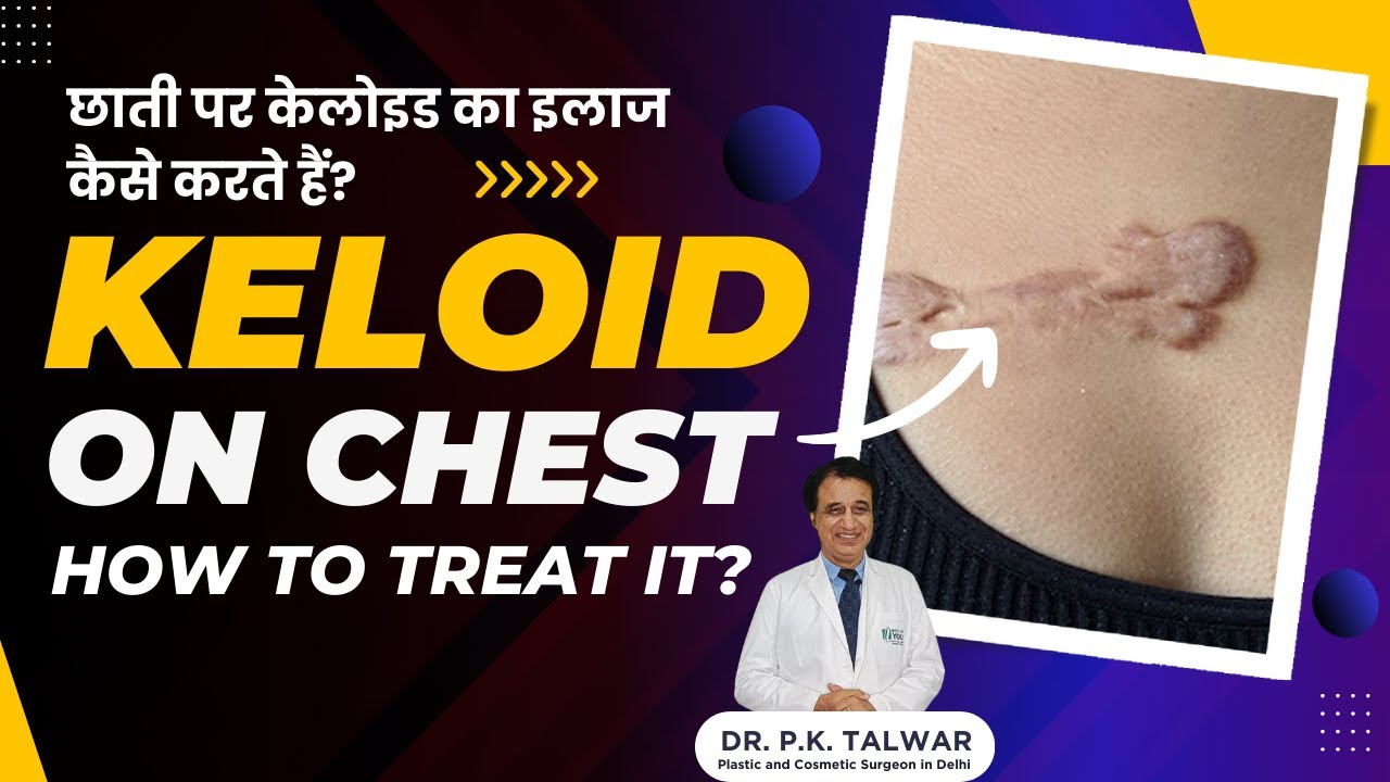 Treatment of Keloid on Chest | Keloid Treatment In Delhi | Dr. PK ...