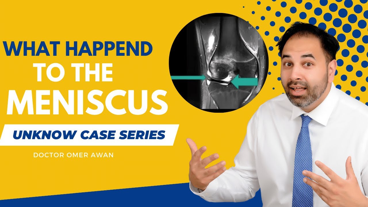 The Radiology of Rare Knee Conditions: Discoid Meniscus | Dr omer Awan ...
