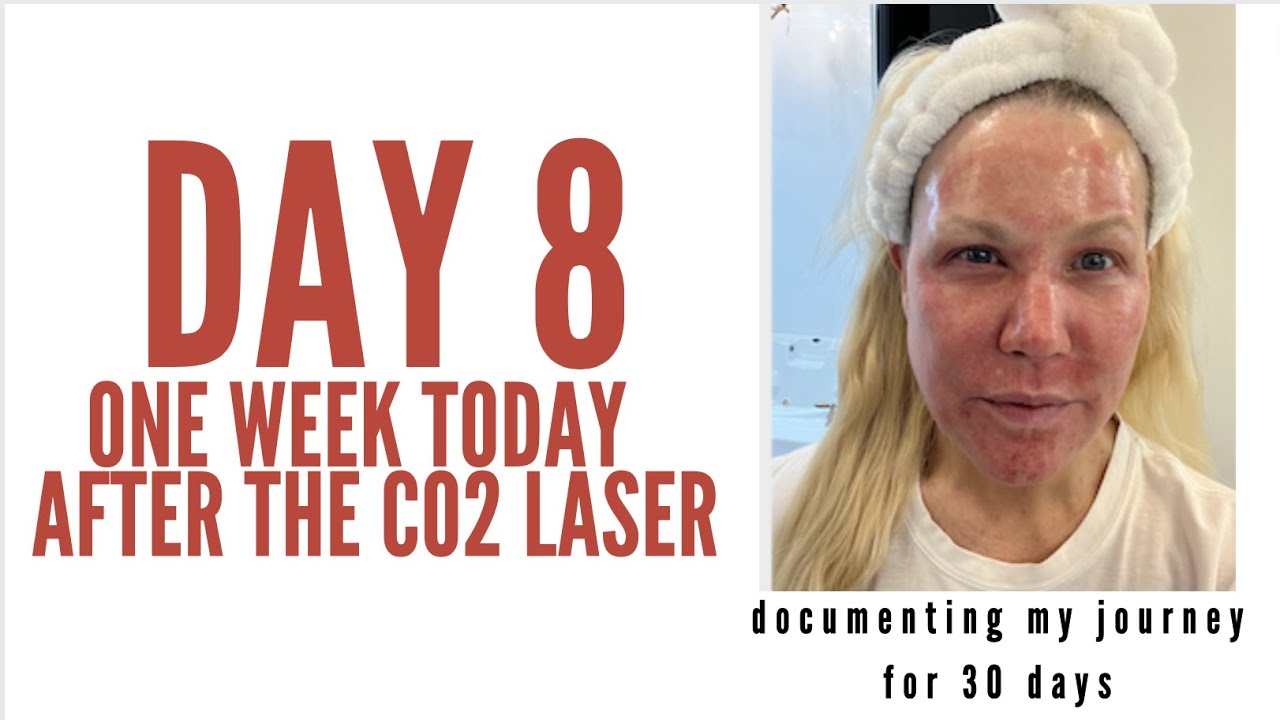 ONE WEEK Post CO2 Laser What Do I Look Like At One Week YouTube one-week-post-co2-laser-what-do-i-look-like-at-one-week-youtube