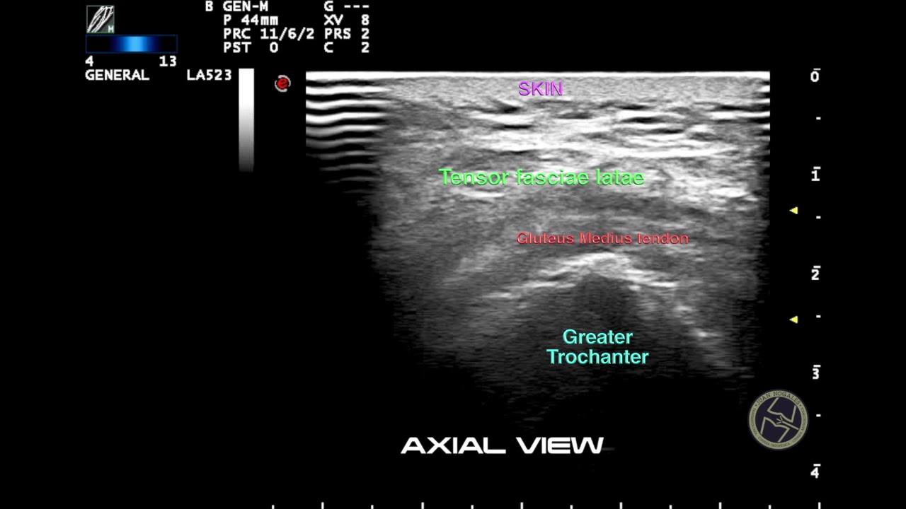ULTRASOUND AND GREATER TROCHANTER PAIN SYNDROME - YouTube