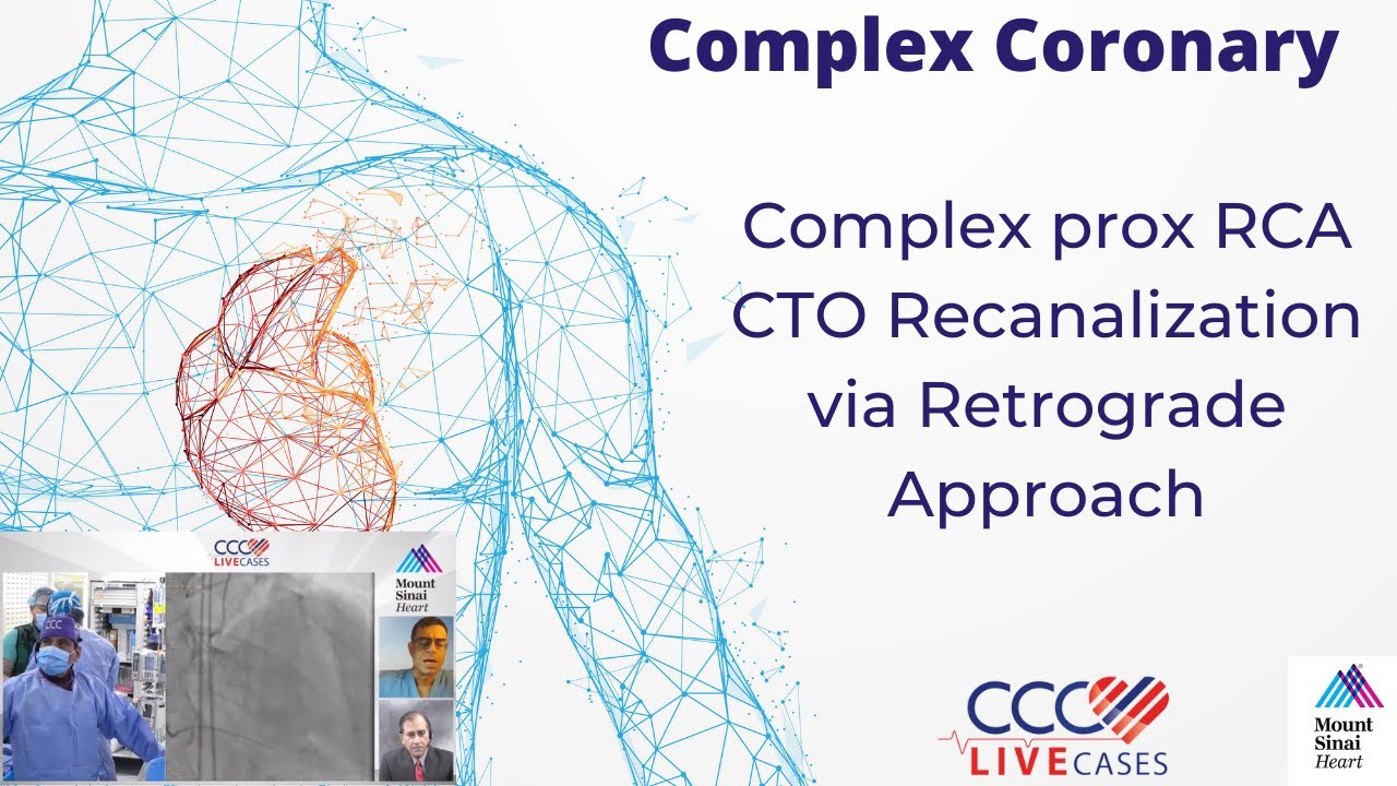 Complex prox RCA CTO Recanalization via Retrograde Approach - YouTube