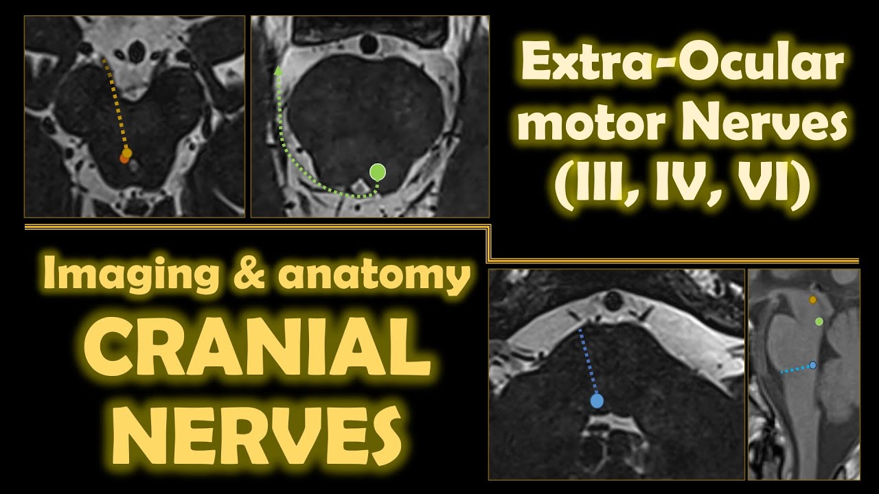 Cranial Nerve Anatomy - The extra-oculor motor nerves (III, IV, VI ...