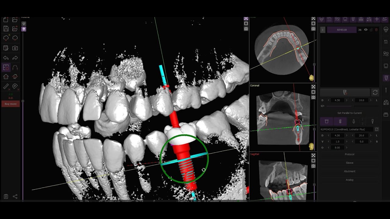 Step-by-Step Implant Placement. Library Implant. - YouTube