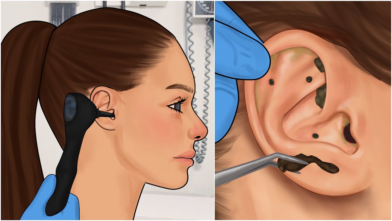 ASMR Oddly Satisfying | Massive Earwax Removal | Ear Cleaning, Sebum ...