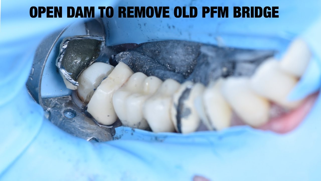 BRIDGE REMOVED WITH OPEN DAM - YouTube