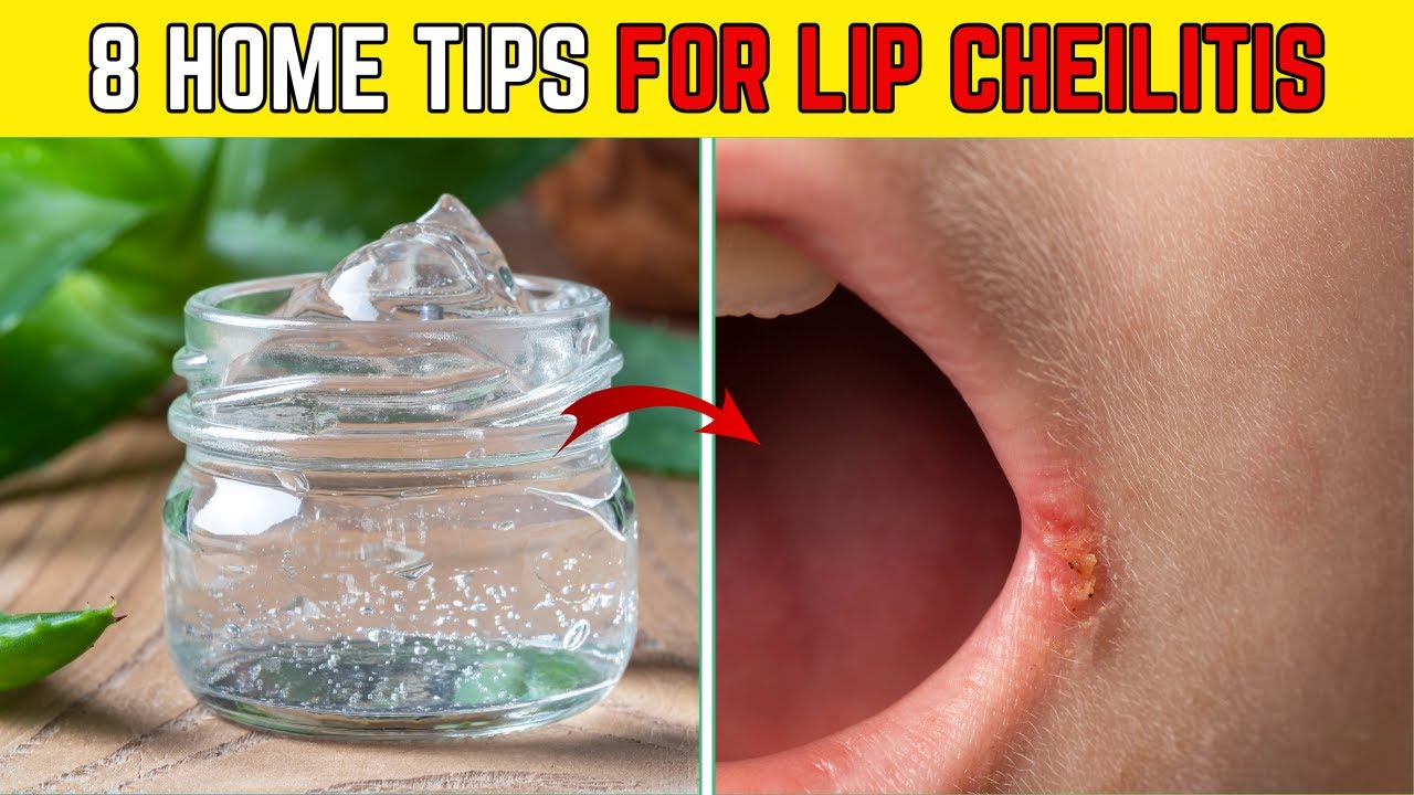 "Unlocking the Secrets of Lip Cheilitis: Comprehensive Guide to Types ...